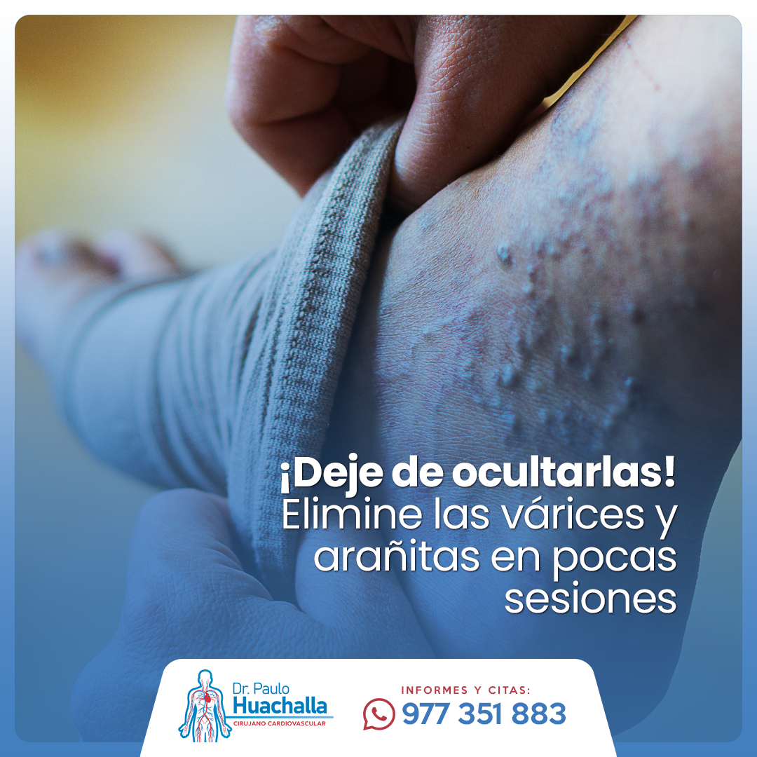 ¿Porqué aparecen las varices y cómo podemos evitarlas? - Cirujano ...