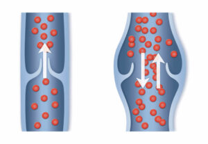 Qué son las várices y cuál es su tratamiento