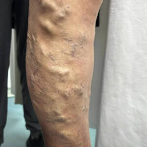 Tipos de Várices: Fotos y Videos