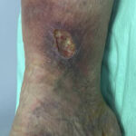 Tipos de Várices: Fotos y Videos