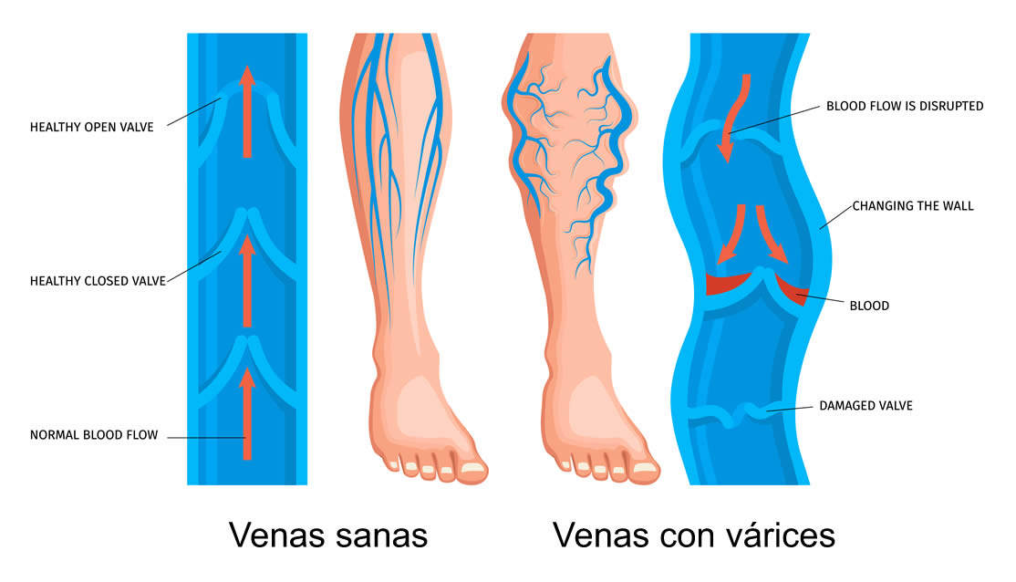 Las complicaciones en várices se producen por no tratarse con el ...